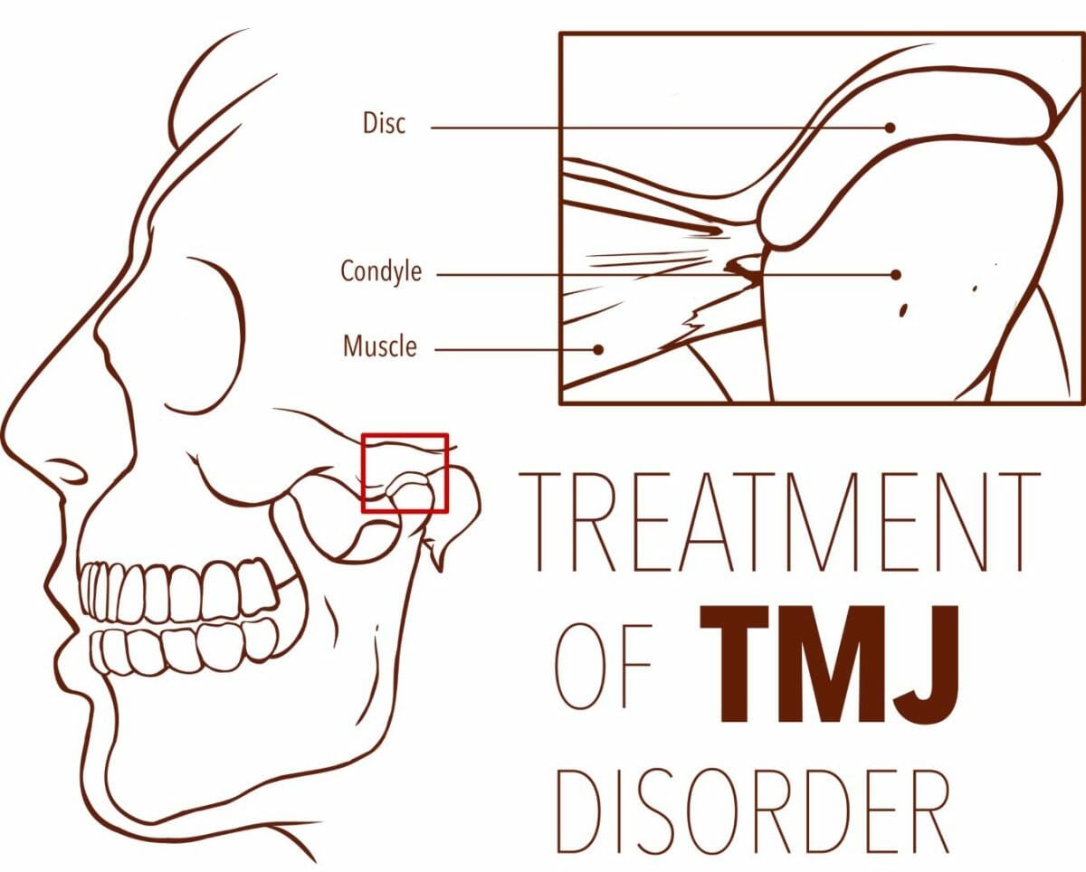 The Best Treatments For TMJ – So You Can Feel Better | New York TMJ ...
