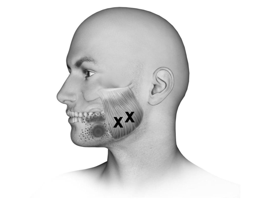 The Secret Behind Unexplained Toothaches & Facial Pain | New York TMJ ...