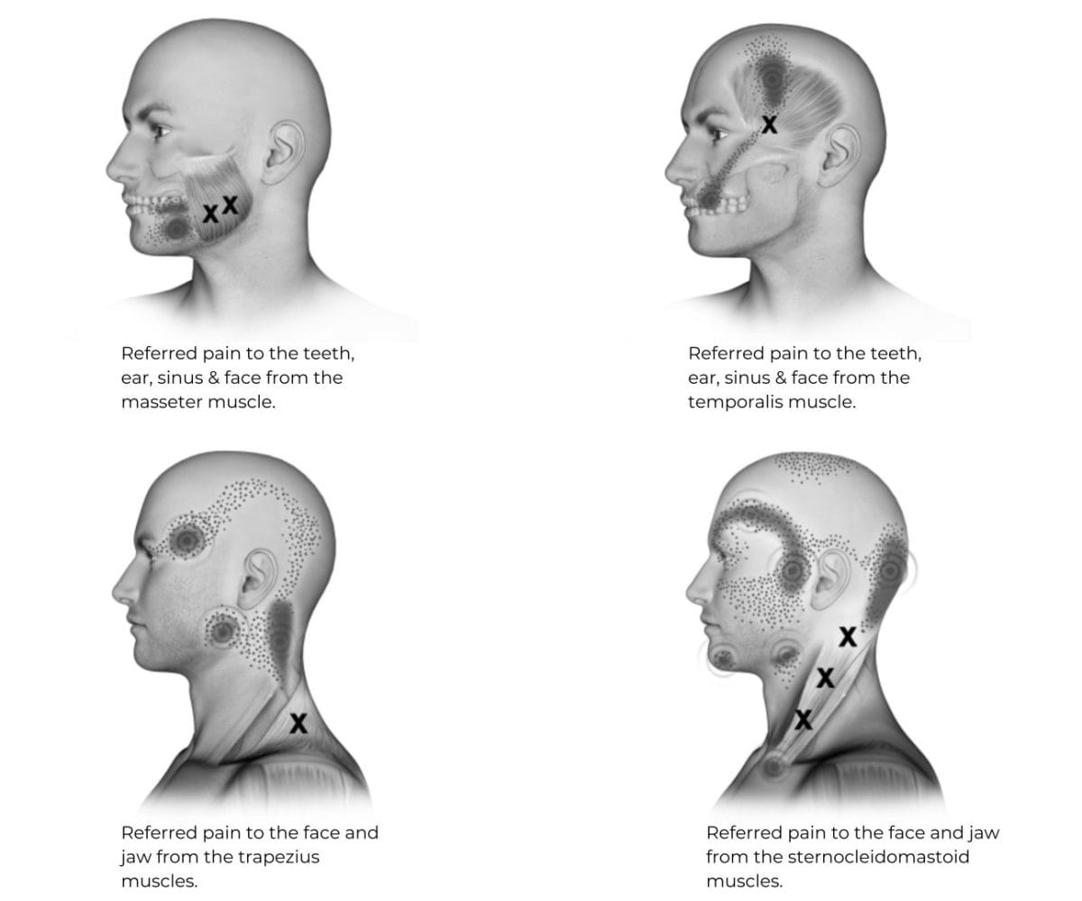 Heterotopic Pain & Its Role In Facial Pain | New York TMJ & Orofacial Pain