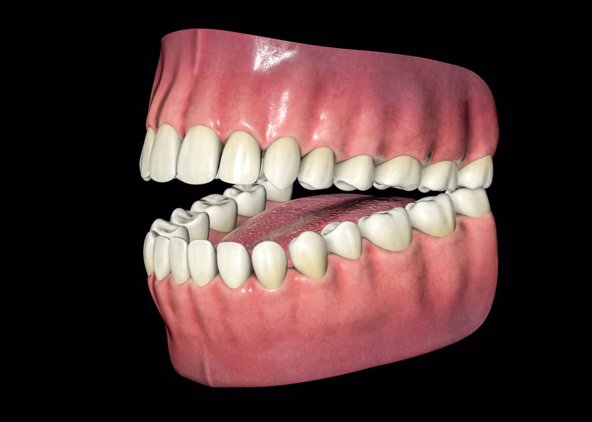 Unlocking the Mysteries of Open Bite: A Case Study | New York TMJ ...